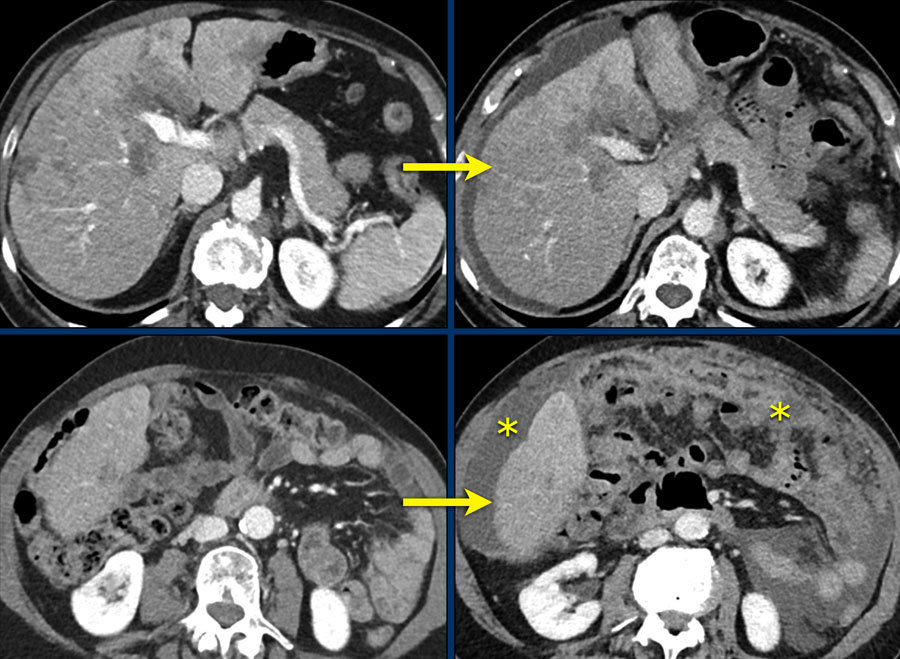 The Radiology Assistant : RECIST 1.1 - examples The Radiology Assistant : RECIST 1.1 - examples