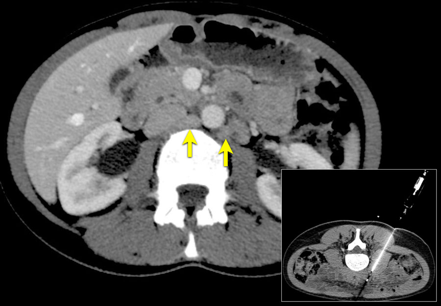 The Radiology Assistant Pancreatic Cancer Ct Staging 2 0