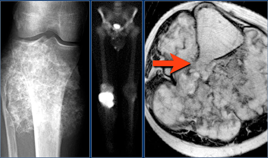 The Radiology Assistant : Bone tumor H-O