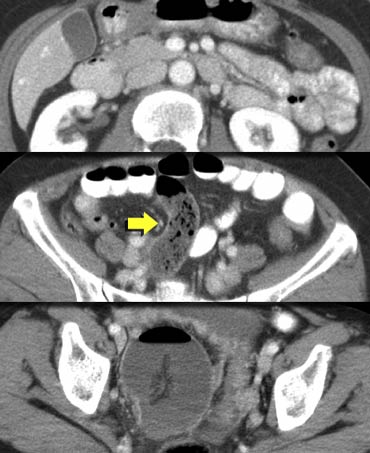 The Radiology Assistant : Closed Loop in Small bowel obstruction