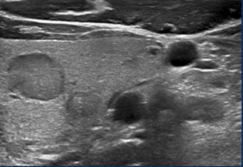 The Radiology Assistant : TI-RADS - Thyroid Imaging Reporting and Data ...