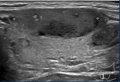The Radiology Assistant : TI-RADS - Thyroid Imaging Reporting and Data ...