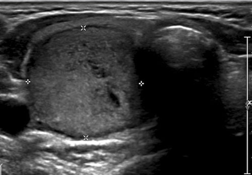 The Radiology Assistant : TI-RADS - Thyroid Imaging Reporting and Data ...