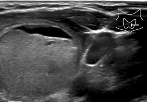 The Radiology Assistant : TI-RADS - Thyroid Imaging Reporting and Data ...
