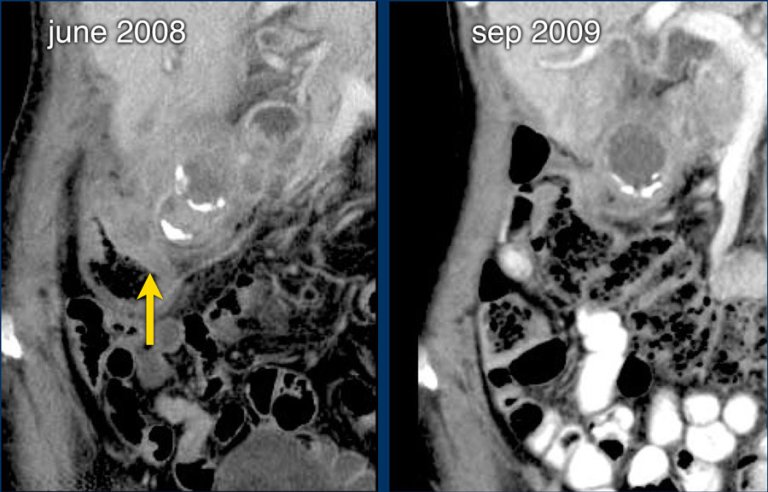 The Radiology Assistant : Gallbladder obstruction