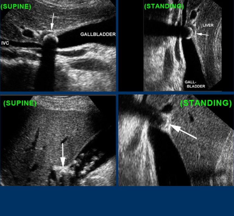 The Radiology Assistant : Gallbladder obstruction