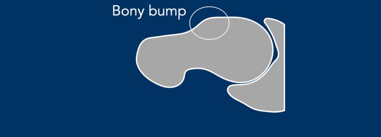 The Radiology Assistant : Femoroacetabular impingement syndrome