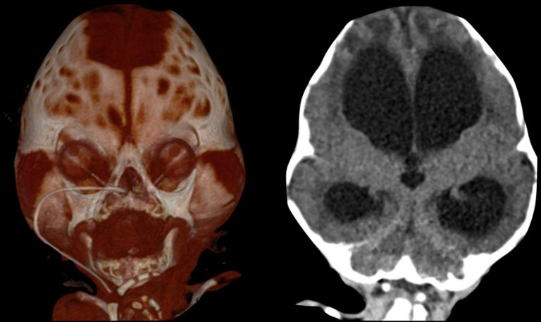 The Radiology Assistant : Craniosynostosis
