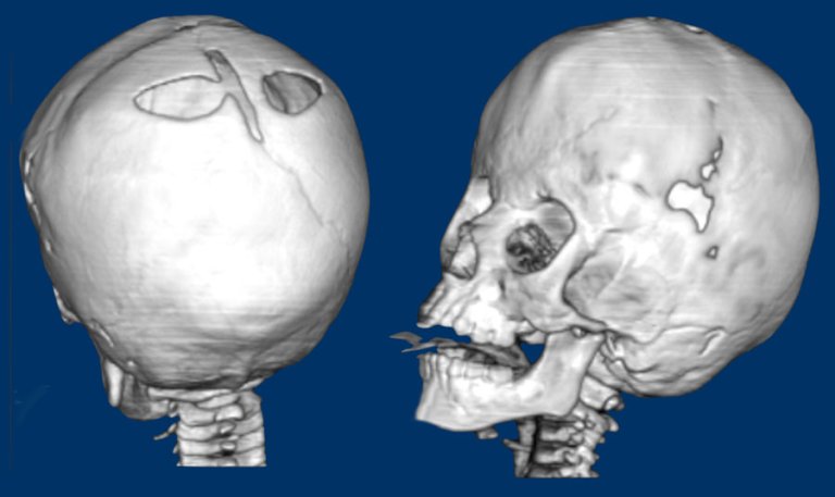 The Radiology Assistant : Craniosynostosis