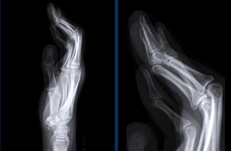 The Radiology Assistant : Arthritis