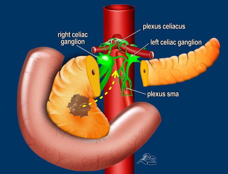 The Radiology Assistant : Pancreatic Cancer - CT staging 2.0