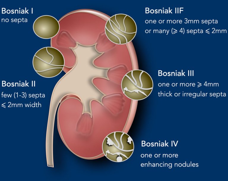 The Radiology Assistant : Bosniak Classification 2019