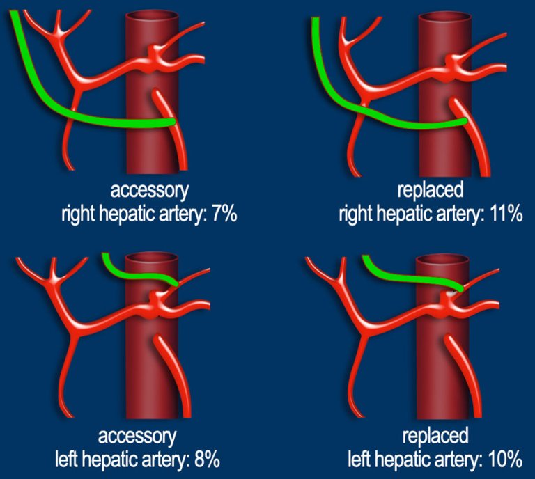 The Radiology Assistant : Pancreatic Cancer - CT staging 2.0