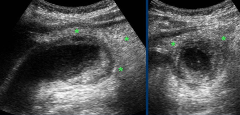 The Radiology Assistant : Gallbladder obstruction