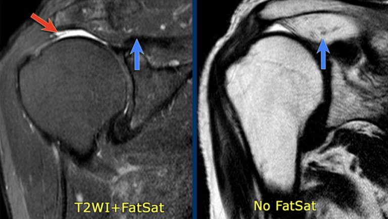 The Radiology Assistant : Shoulder Rotator cuff injury