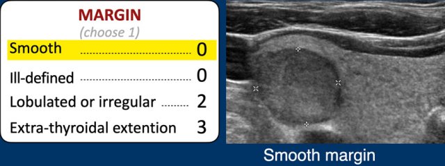 The Radiology Assistant : TI-RADS - Thyroid Imaging Reporting and Data ...