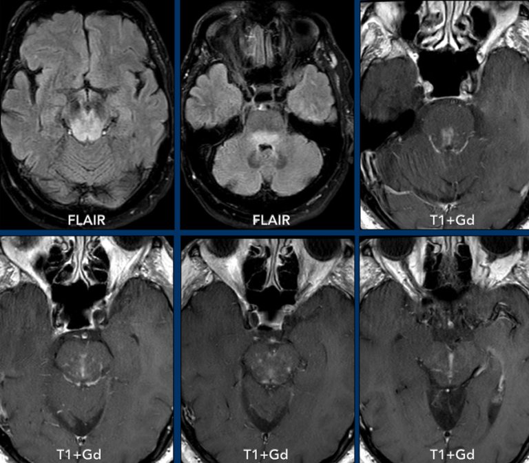 The Radiology Assistant : Enhancement Patterns in CNS disease