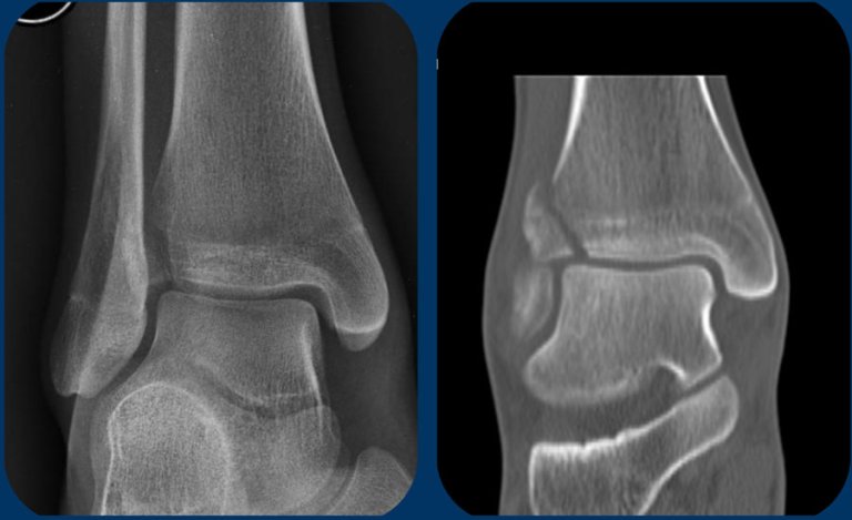 The Radiology Assistant : Algoritm for Ankle Fractures 2.0