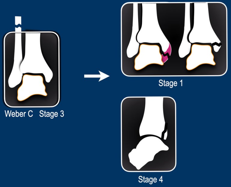 The Radiology Assistant : Algoritm for Ankle Fractures 2.0