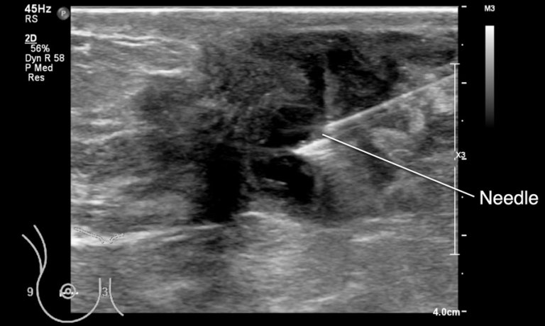 The Radiology Assistant : Ultrasound of the Breast