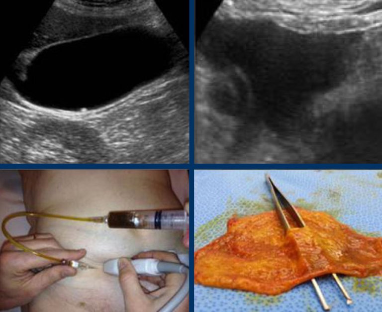 The Radiology Assistant : Gallbladder obstruction