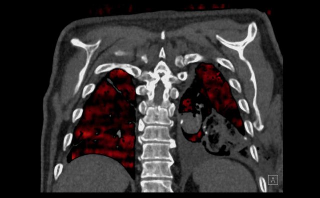 The Radiology Assistant : Lung Segments and Bronchi