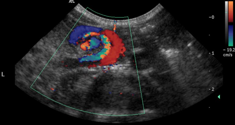 The Radiology Assistant : Acute Abdomen in Neonates