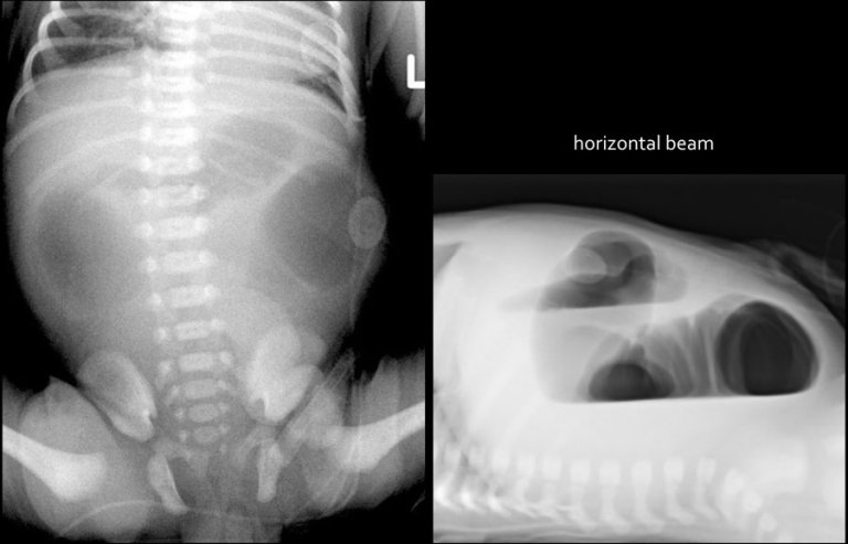 The Radiology Assistant : Acute Abdomen in Neonates