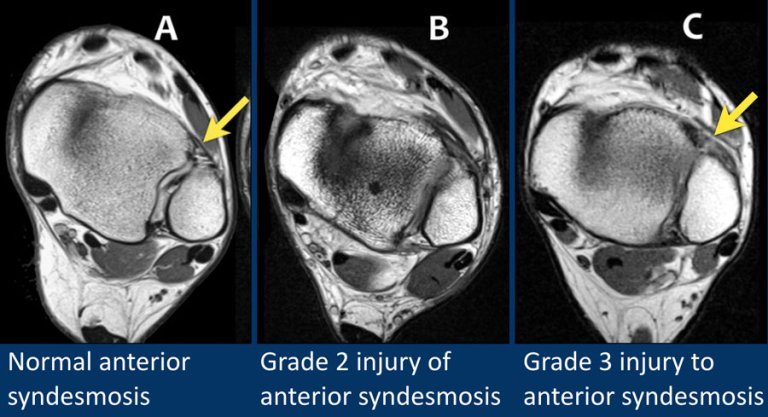 The Radiology Assistant : MRI examination of the ankle