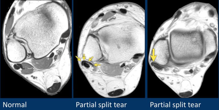 The Radiology Assistant : MRI examination of the ankle
