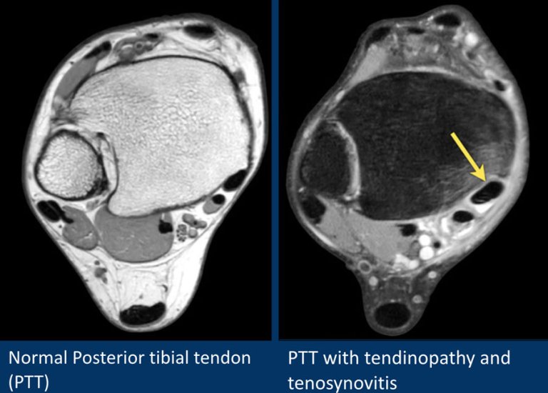 The Radiology Assistant : MRI examination of the ankle