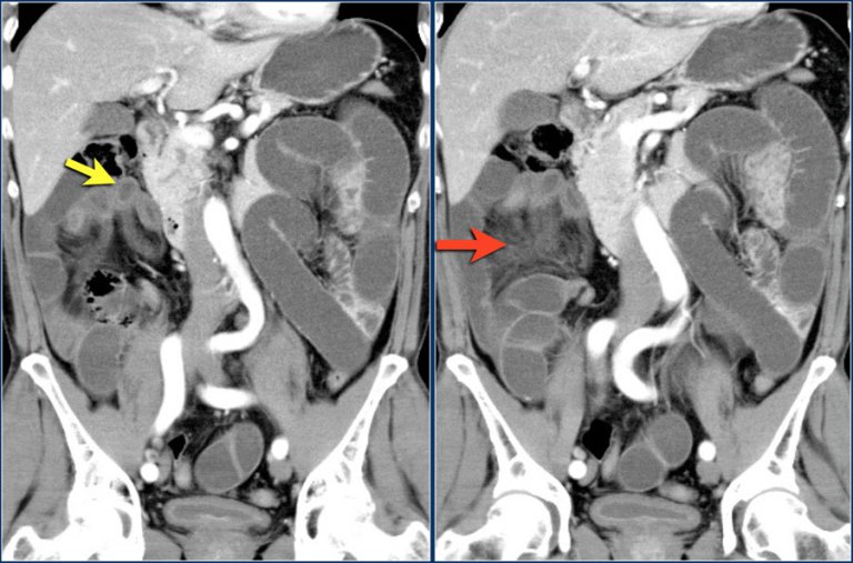 The Radiology Assistant : CT-pattern of Bowel wall thickening