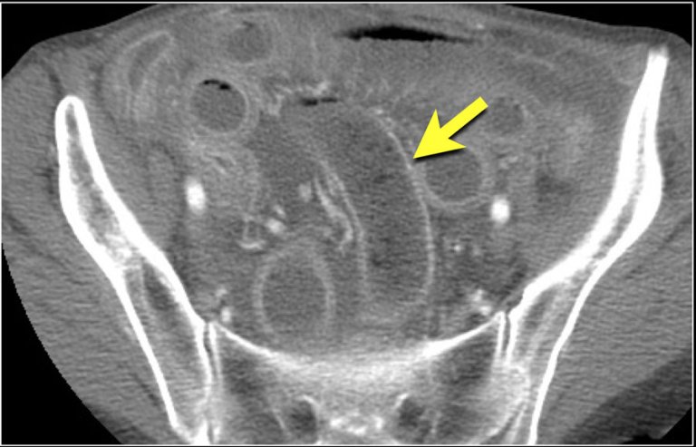 The Radiology Assistant : CT-pattern of Bowel wall thickening