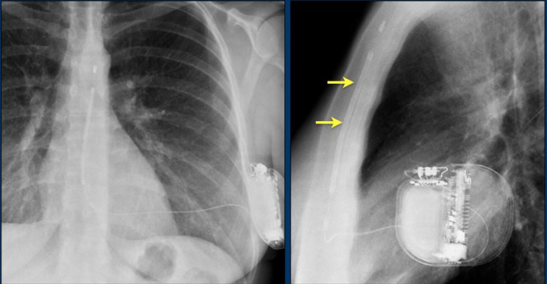 The Radiology Assistant : Cardiovascular devices