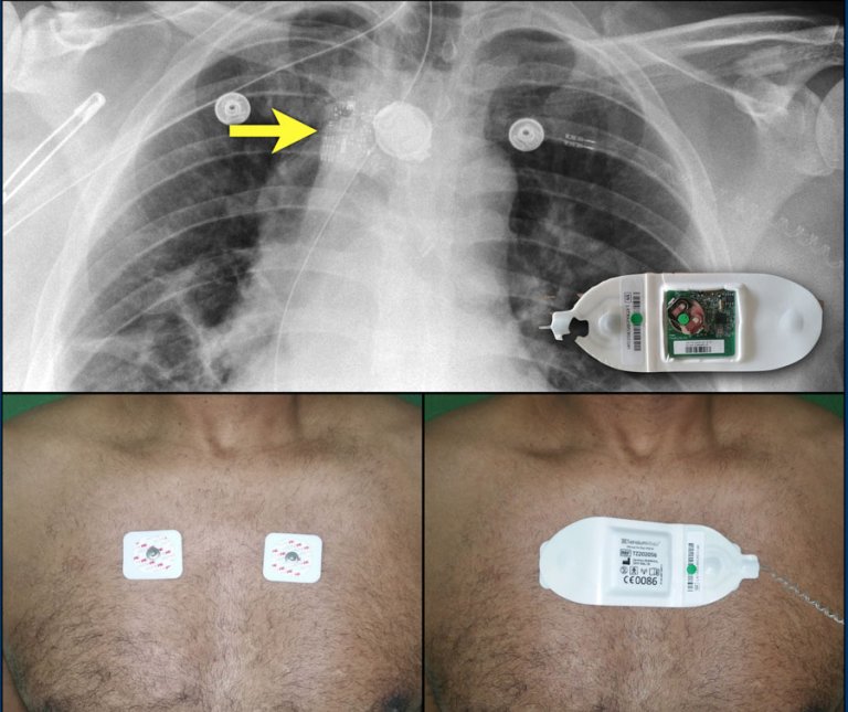 The Radiology Assistant : Cardiovascular devices