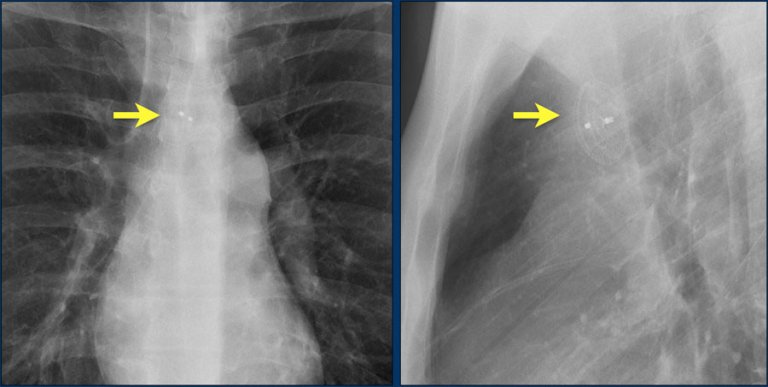 The Radiology Assistant : Cardiovascular devices