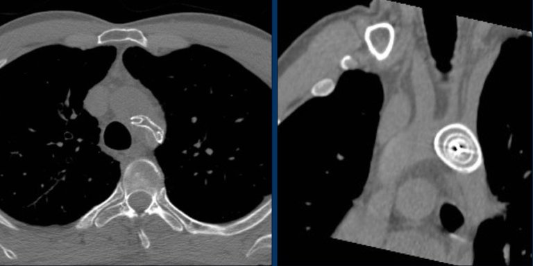 The Radiology Assistant : Cardiovascular devices