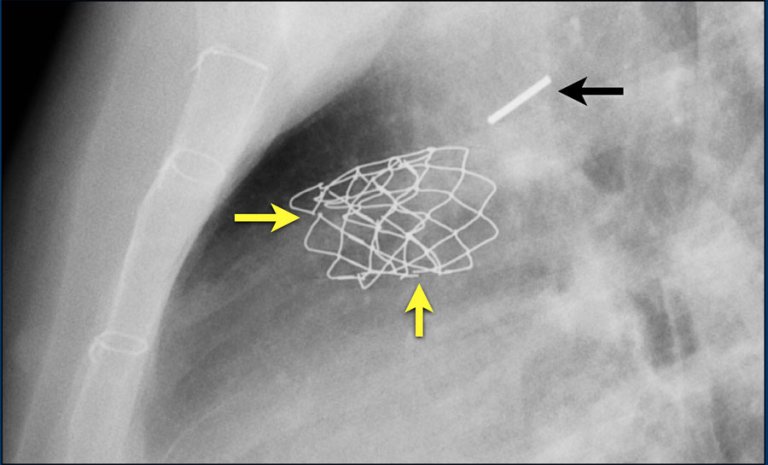 The Radiology Assistant : Cardiovascular devices