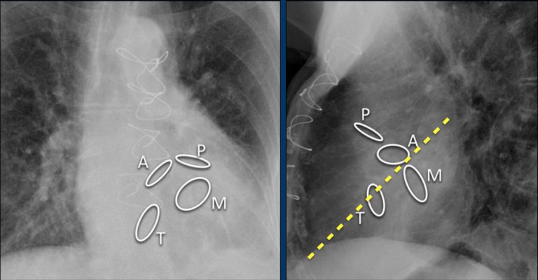 The Radiology Assistant : Cardiovascular devices