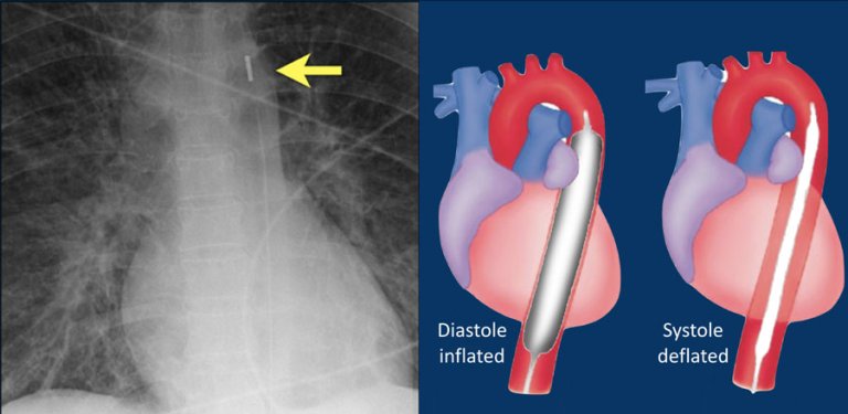 The Radiology Assistant : Cardiovascular devices
