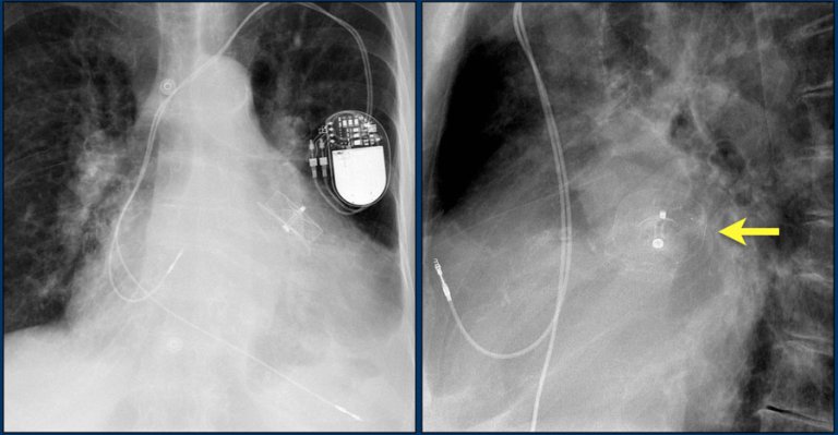 The Radiology Assistant : Cardiovascular devices