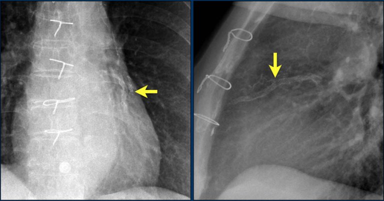 The Radiology Assistant : Cardiovascular devices