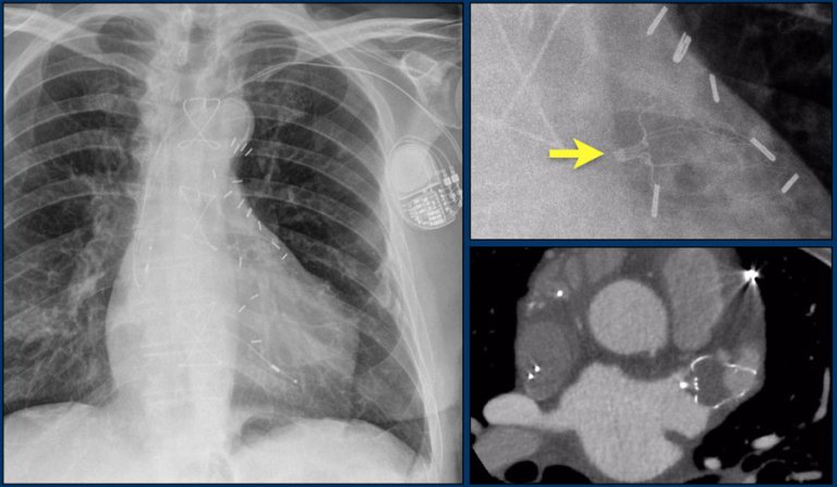 The Radiology Assistant : Cardiovascular devices