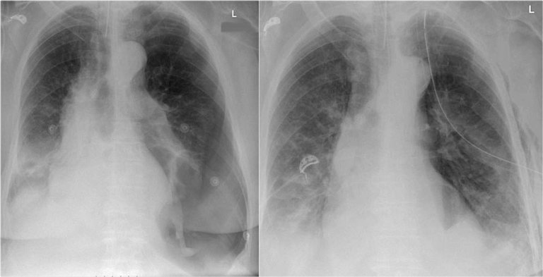 The Radiology Assistant : Chest X-Ray - Basic Interpretation