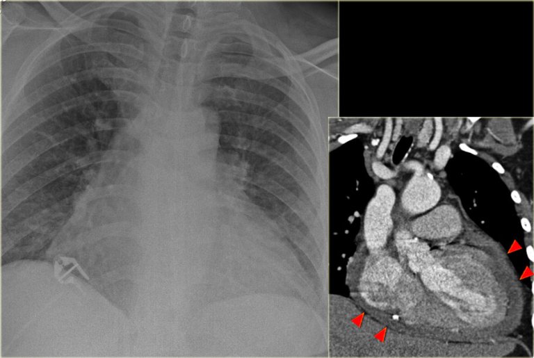 The Radiology Assistant : Chest X-Ray - Heart Failure