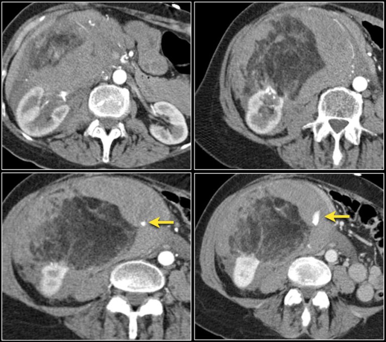 The Radiology Assistant : Solid Renal Masses