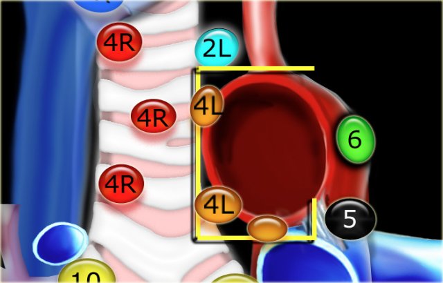 The Radiology Assistant : Mediastinal Lymph Node Map