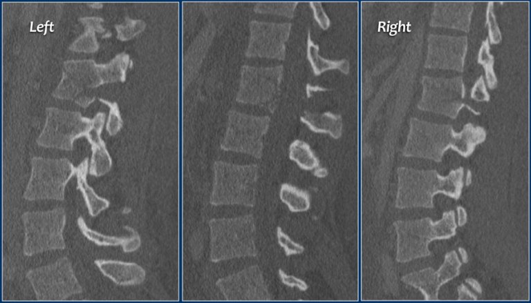 The Radiology Assistant : TLICS Classification of fractures