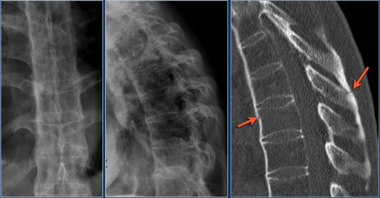The Radiology Assistant : Spine fractures - TLICS Classification