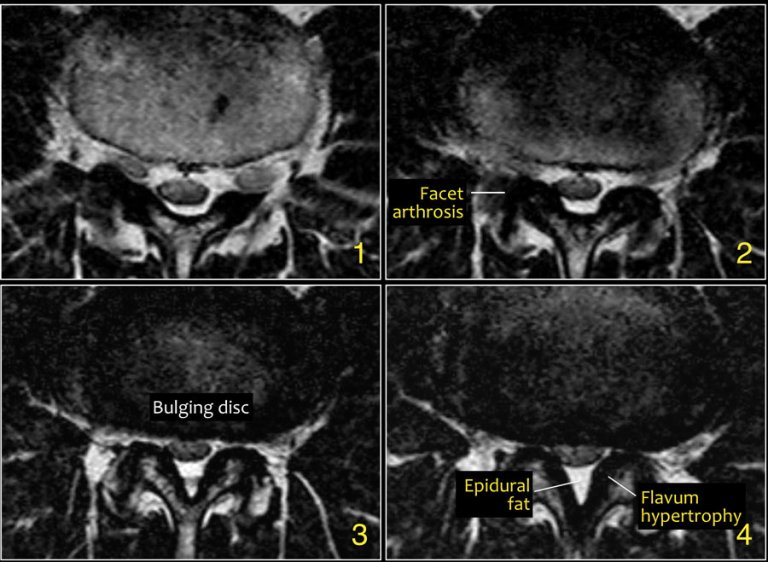 The Radiology Assistant : Lumbar Disc Herniation